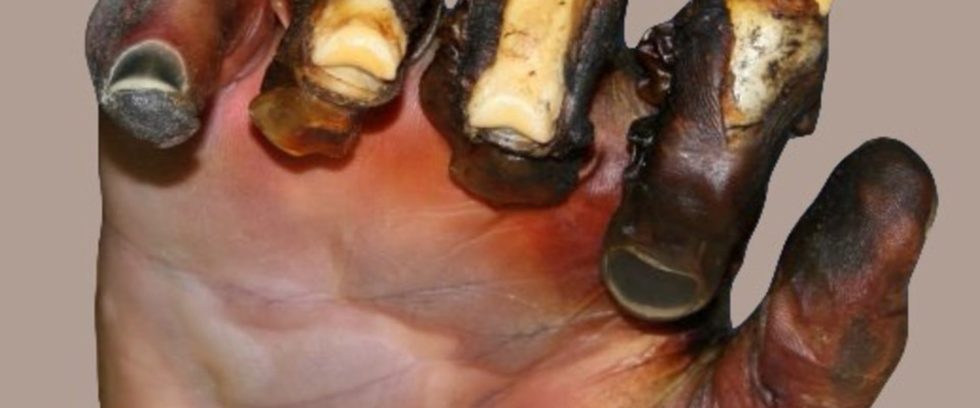 Understanding the Severity of 5th Degree Burns