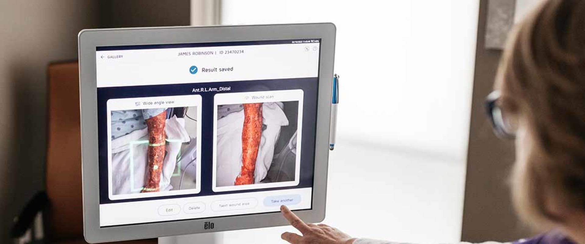 Burn Degree Chart: Must-Know Burn Depths & Healing Facts