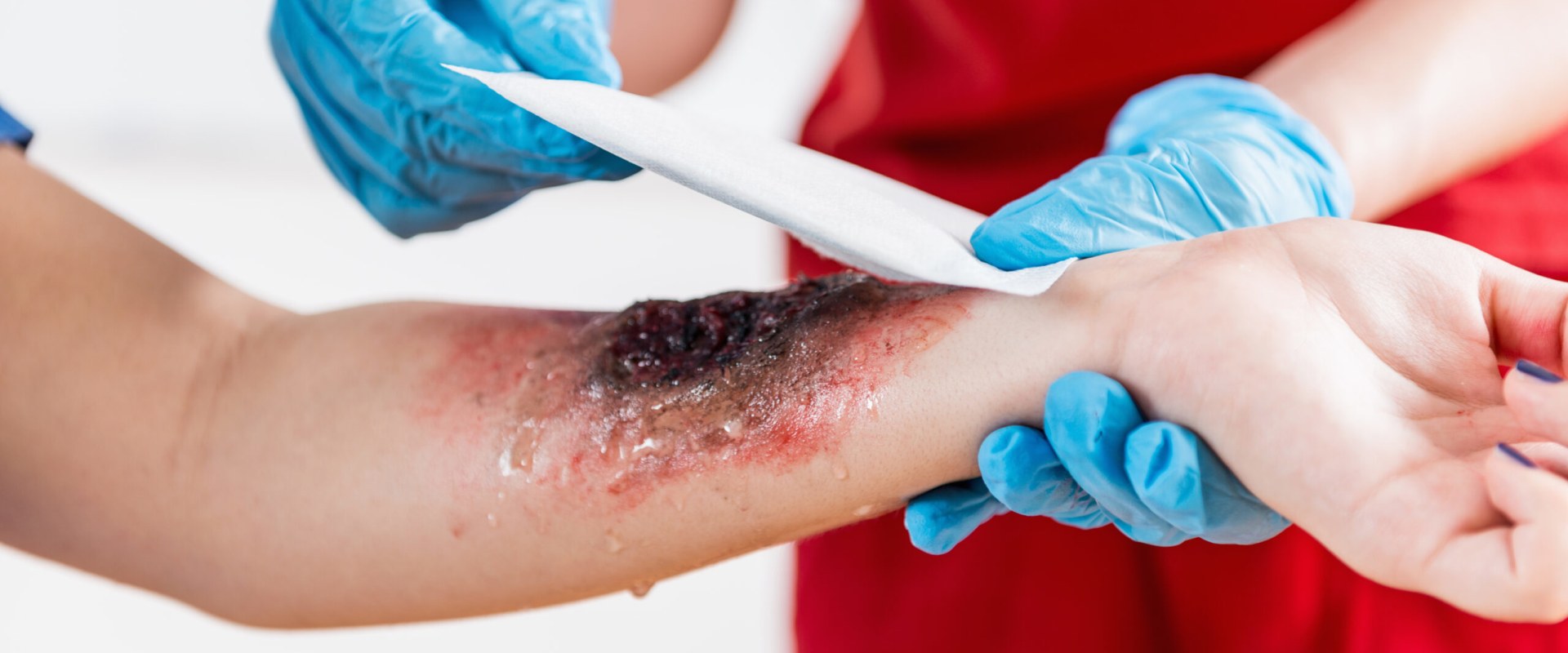 Burn Degree Chart Explained: Spot Burn Severity & Act Fast